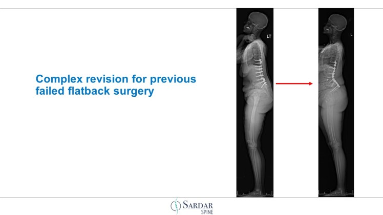 EXTREME SPINAL TRANSFORMATIONS – Sardar Spine – Top Spinal Disorders ...