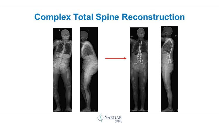 EXTREME SPINAL TRANSFORMATIONS – Sardar Spine – Top Spinal Disorders ...