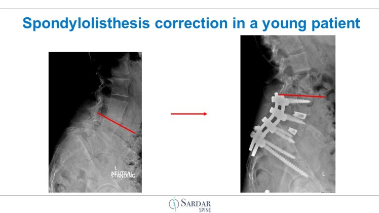 EXTREME SPINAL TRANSFORMATIONS – Sardar Spine – Top Spinal Disorders ...