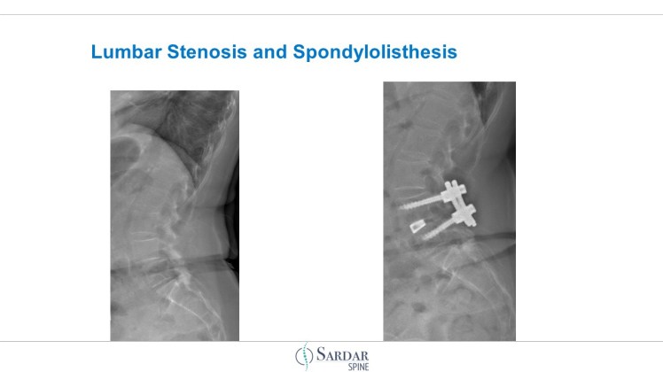 EXTREME SPINAL TRANSFORMATIONS – Sardar Spine – Top Spinal Disorders ...