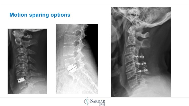 EXTREME SPINAL TRANSFORMATIONS – Sardar Spine – Top Spinal Disorders ...