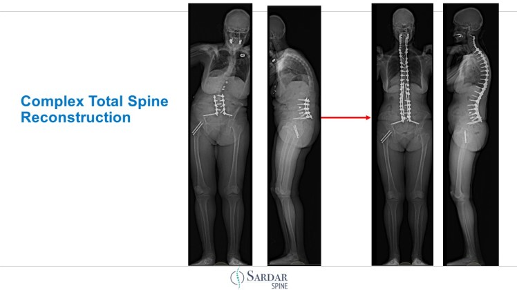 EXTREME SPINAL TRANSFORMATIONS – Sardar Spine – Top Spinal Disorders ...