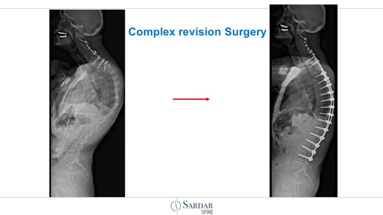 EXTREME SPINAL TRANSFORMATIONS – Sardar Spine – Top Spinal Disorders ...
