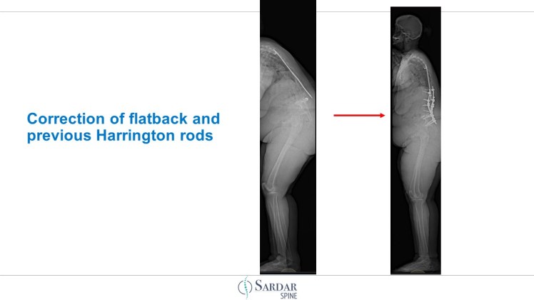 EXTREME SPINAL TRANSFORMATIONS – Sardar Spine – Top Spinal Disorders ...